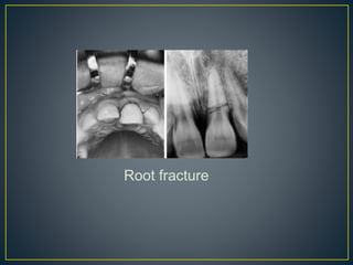 Dental Trauma to Permanent teeth | PPTX