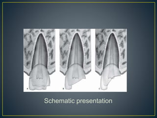 Dental Trauma to Permanent teeth | PPTX