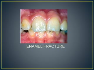 Dental Trauma to Permanent teeth | PPTX