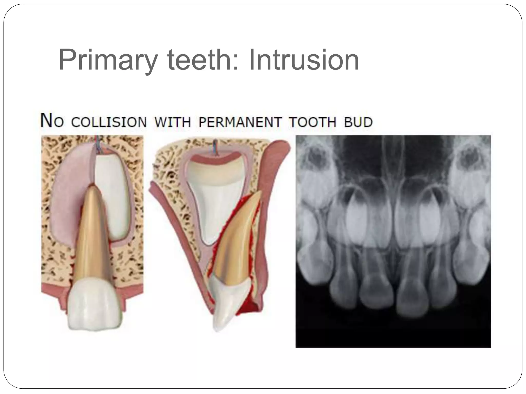 Dental trauma to primary teeth | PPTX