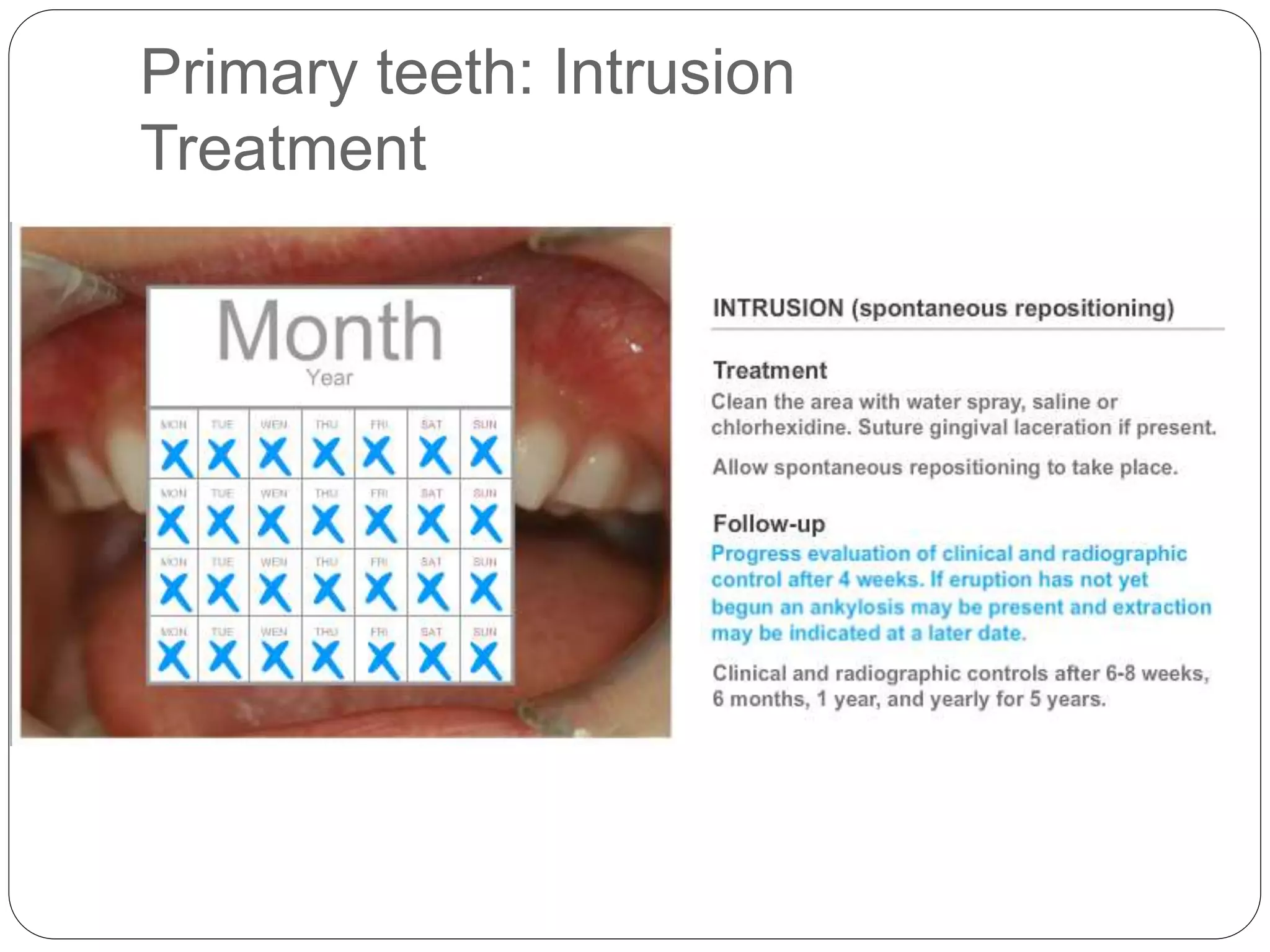 Dental trauma to primary teeth | PPTX