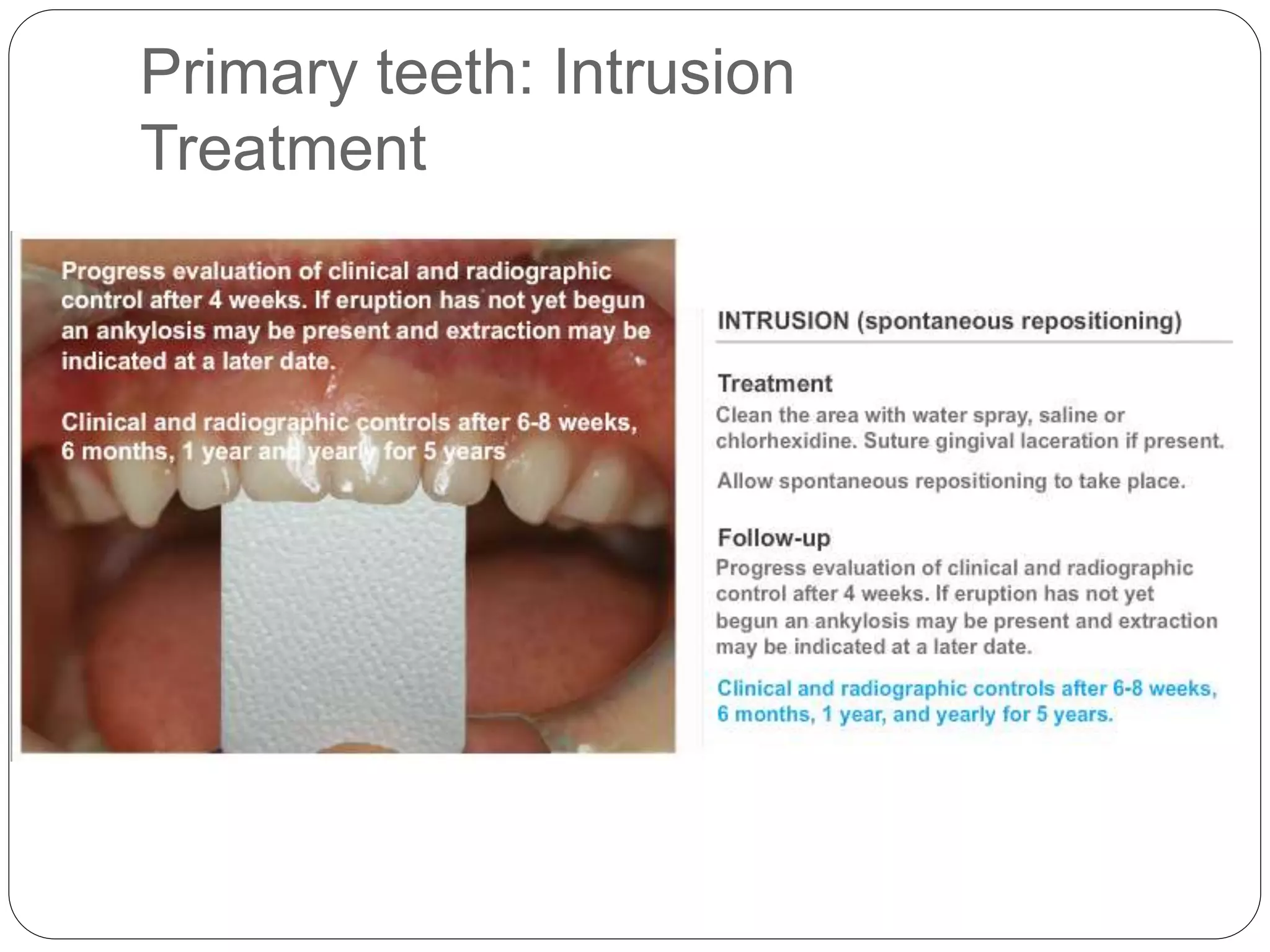 Dental trauma to primary teeth | PPTX