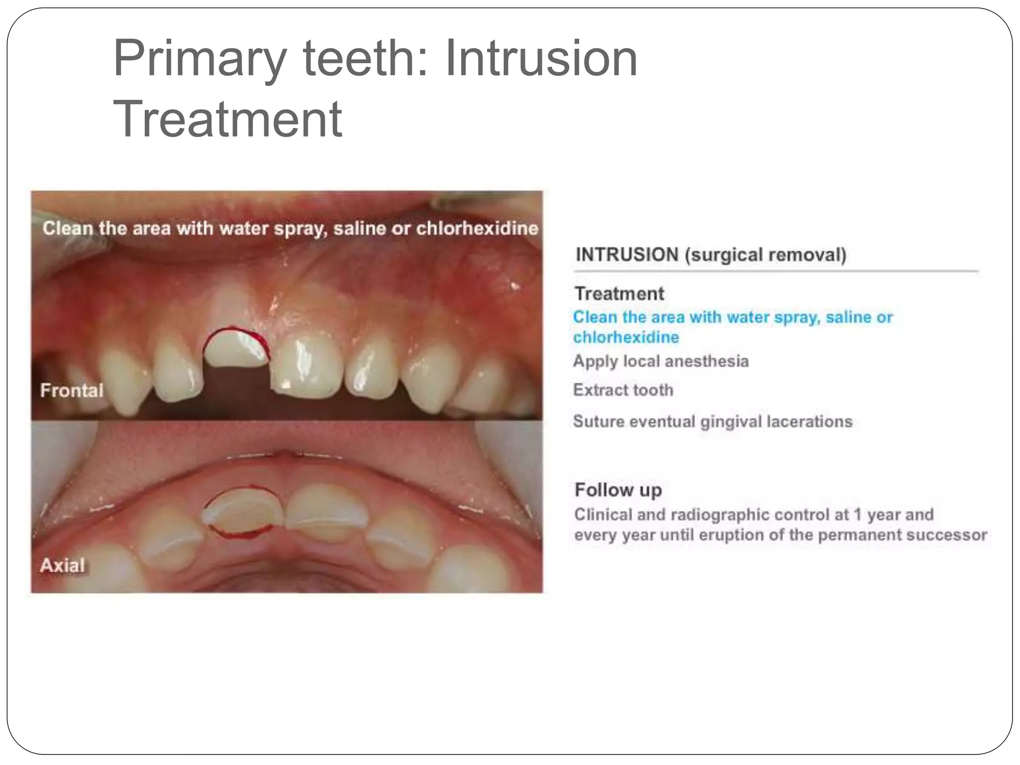 Dental trauma to primary teeth | PPTX