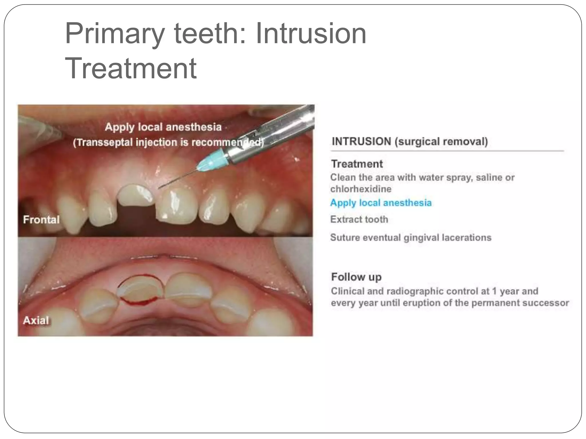 Dental trauma to primary teeth | PPTX