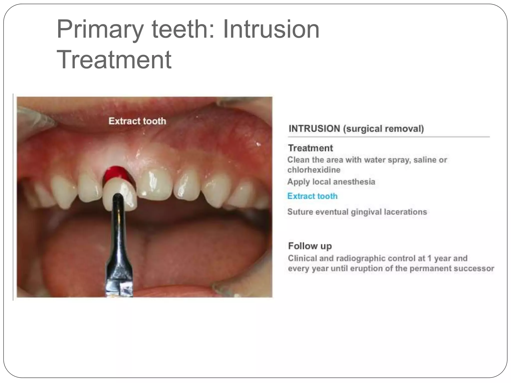 Dental trauma to primary teeth | PPTX