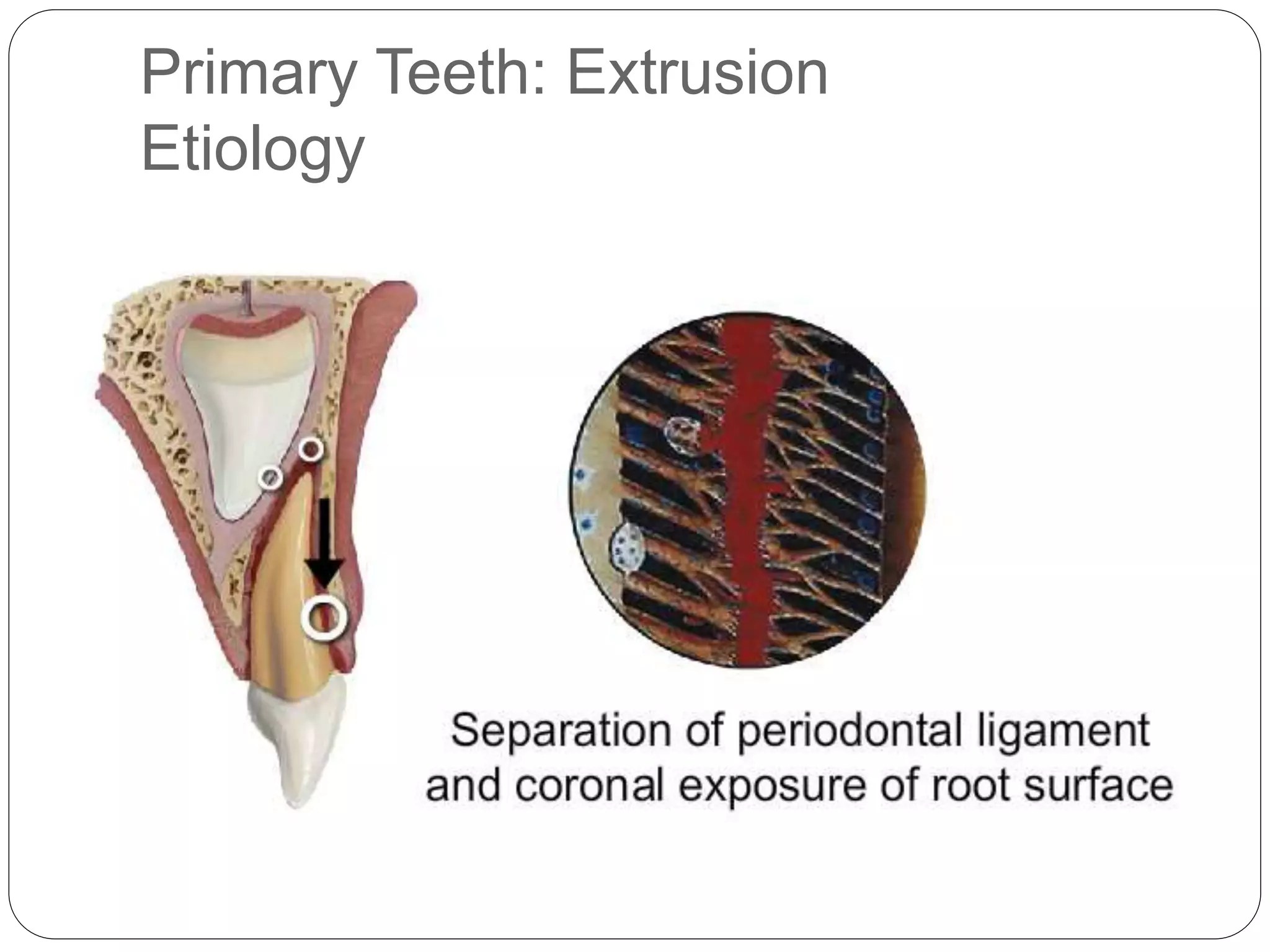 Dental trauma to primary teeth | PPTX