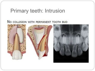Tooth Intrusion Radiograph