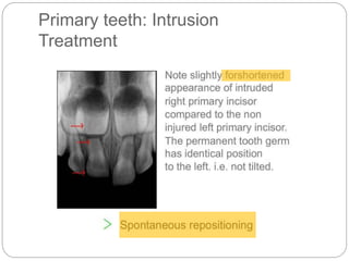 Tooth Intrusion Radiograph