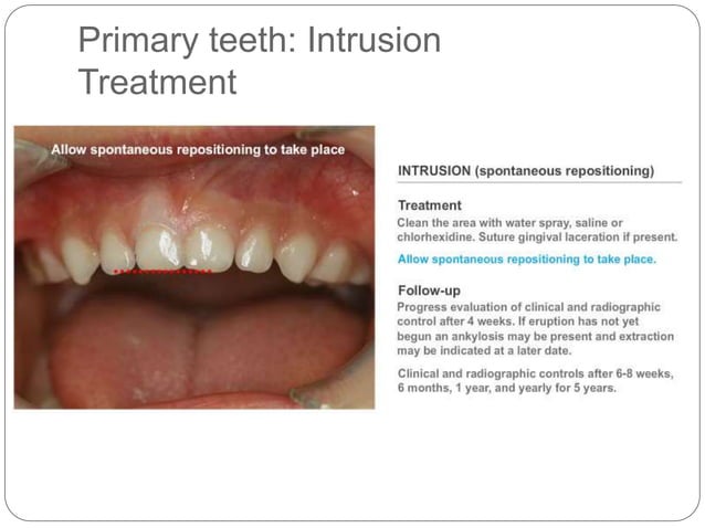 Dental trauma to primary teeth
