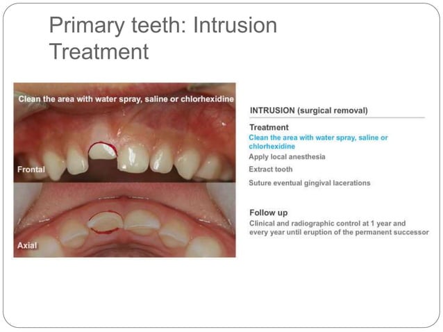 Dental trauma to primary teeth