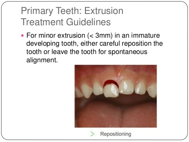 Dental trauma to primary teeth