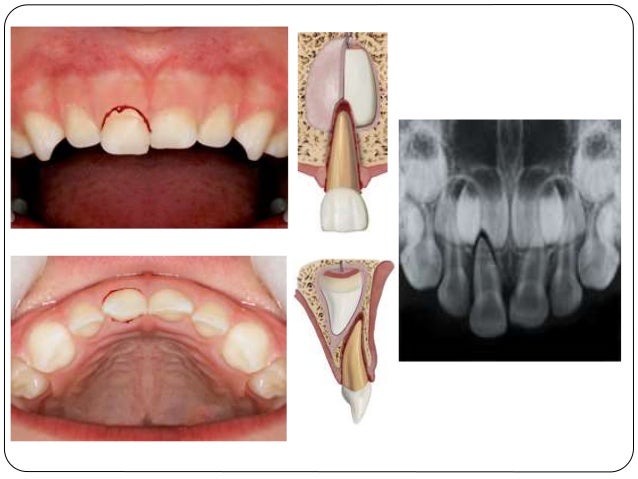 Dental trauma to primary teeth