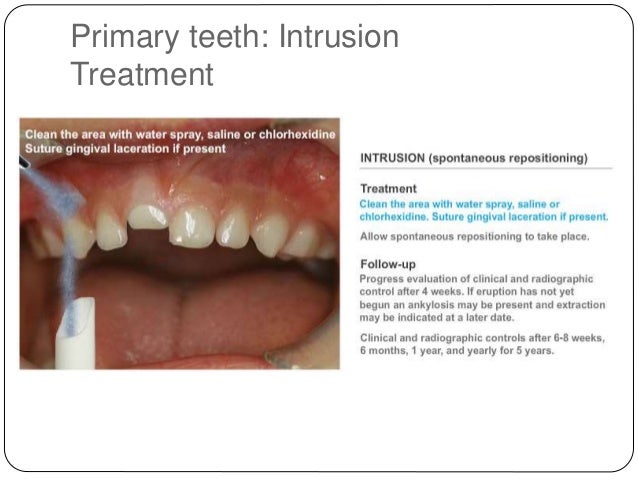 Dental trauma to primary teeth