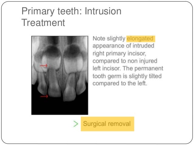 Dental trauma to primary teeth