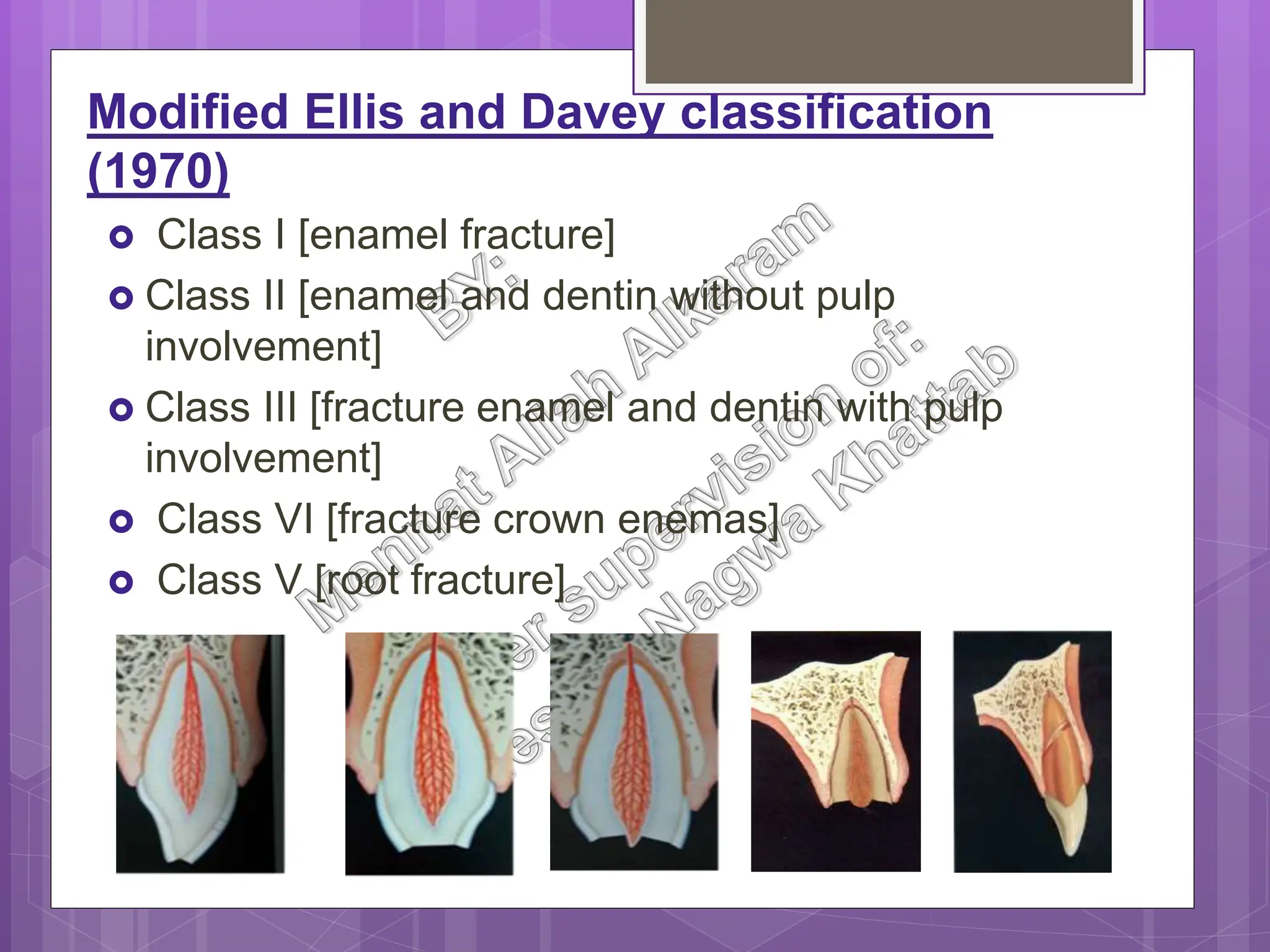management of traumatic dental injuries in children.pptx
