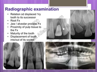 management of traumatic dental injuries in children.pptx