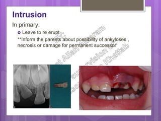 management of traumatic dental injuries in children.pptx