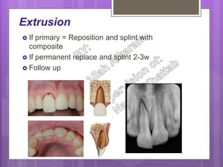 management of traumatic dental injuries in children.pptx