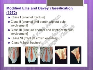 management of traumatic dental injuries in children.pptx