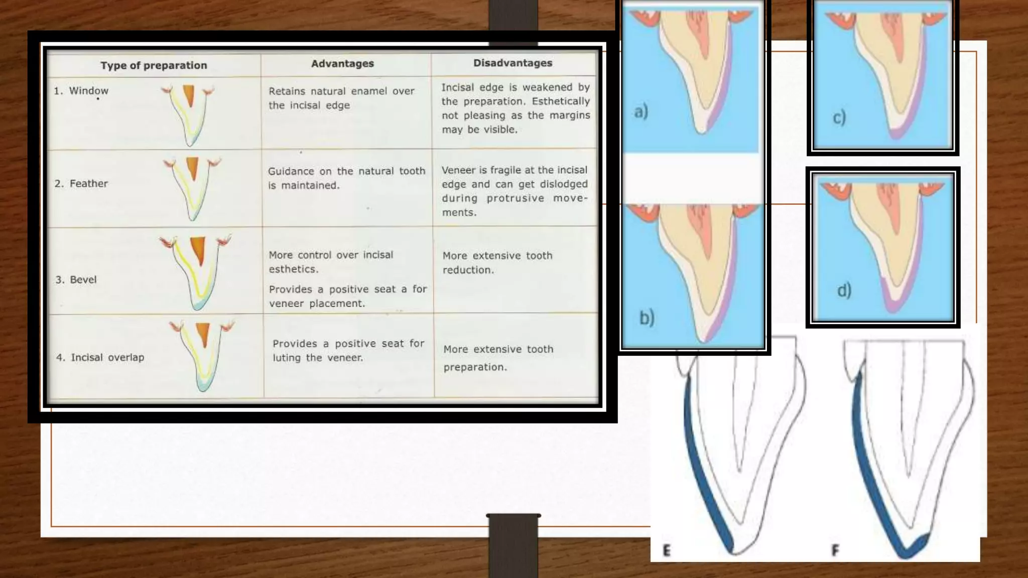 Dental veneer @ | PPTX