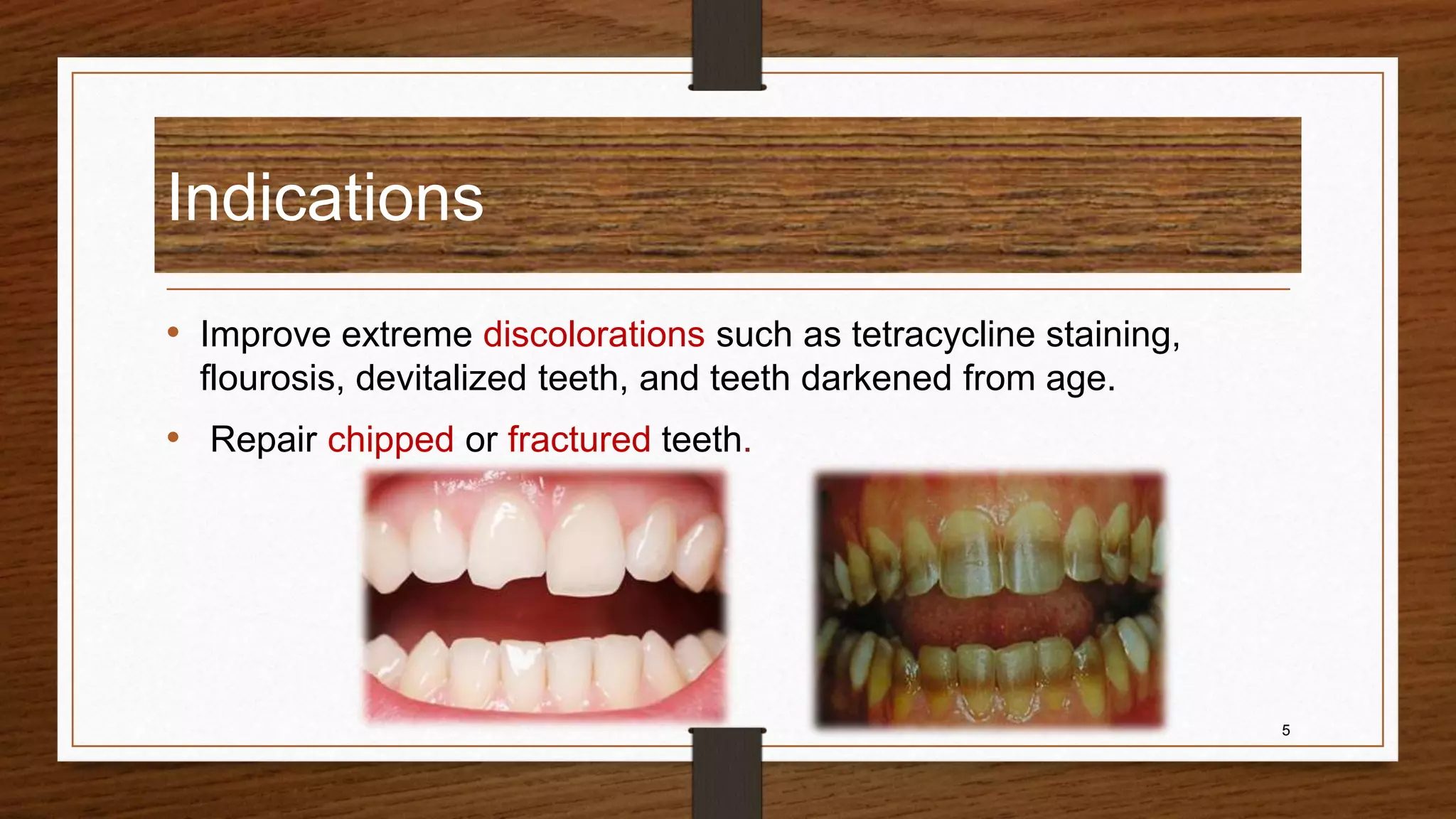 Dental veneer @ | PPTX