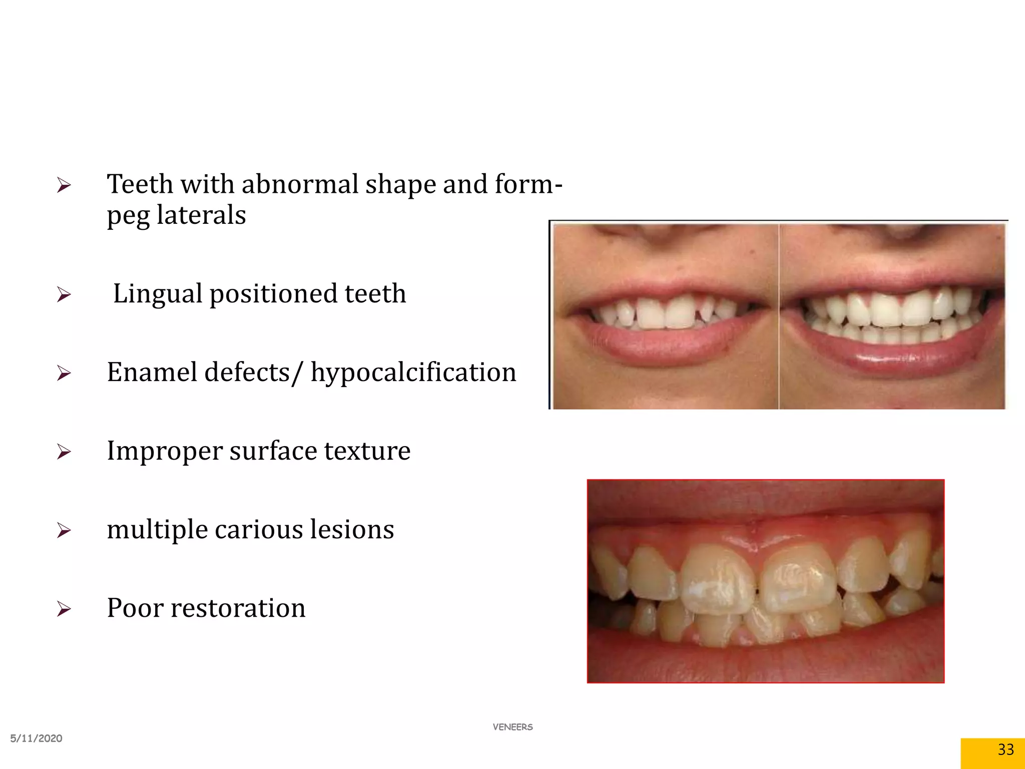 Dental veneer | PPTX