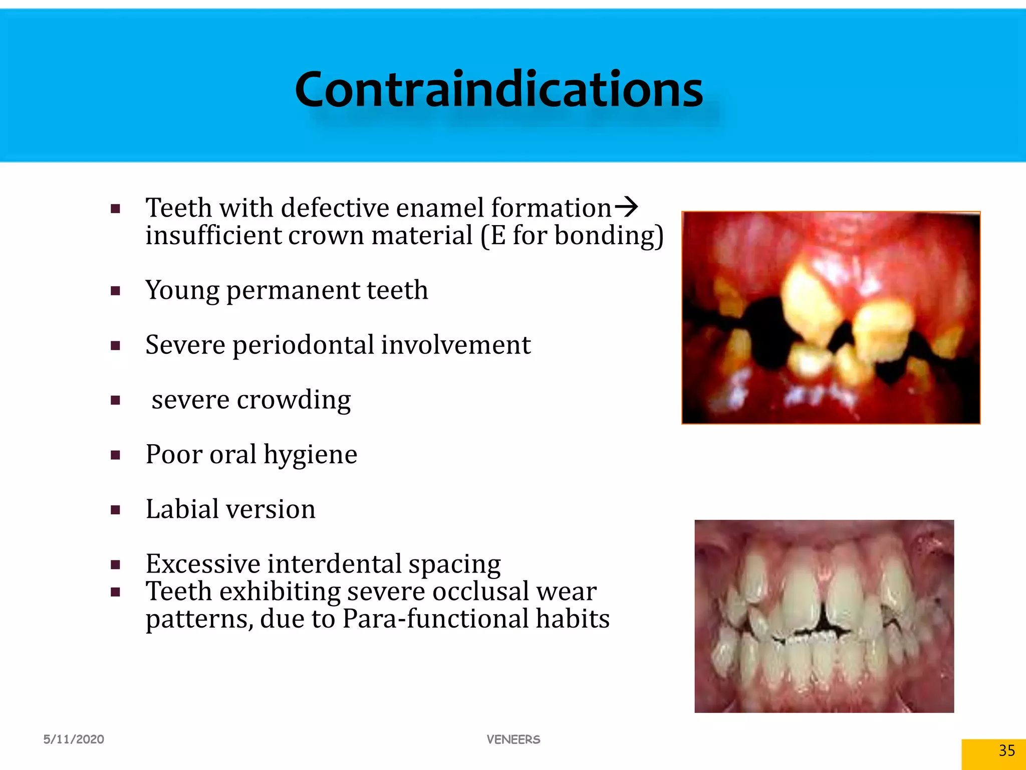 Dental veneer | PPTX