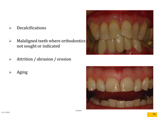 Dental veneer | PPTX | Dental Health | Diseases and Conditions