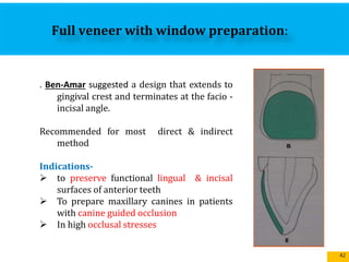 Dental veneer | PPTX