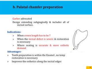 Dental veneer | PPTX