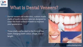 Dental Veneers | PPT
