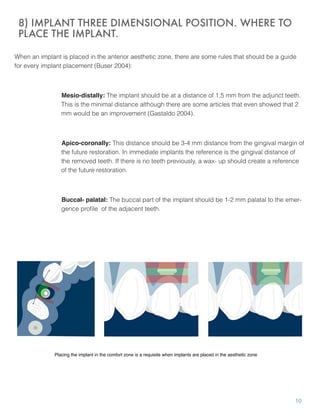 Dentalxp 10 tips for dental implant placement | PDF