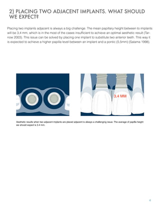 Dentalxp 10 tips for dental implant placement | PDF