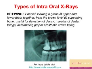 Dental X-Rays | PPT