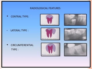 Dentigerous cyst