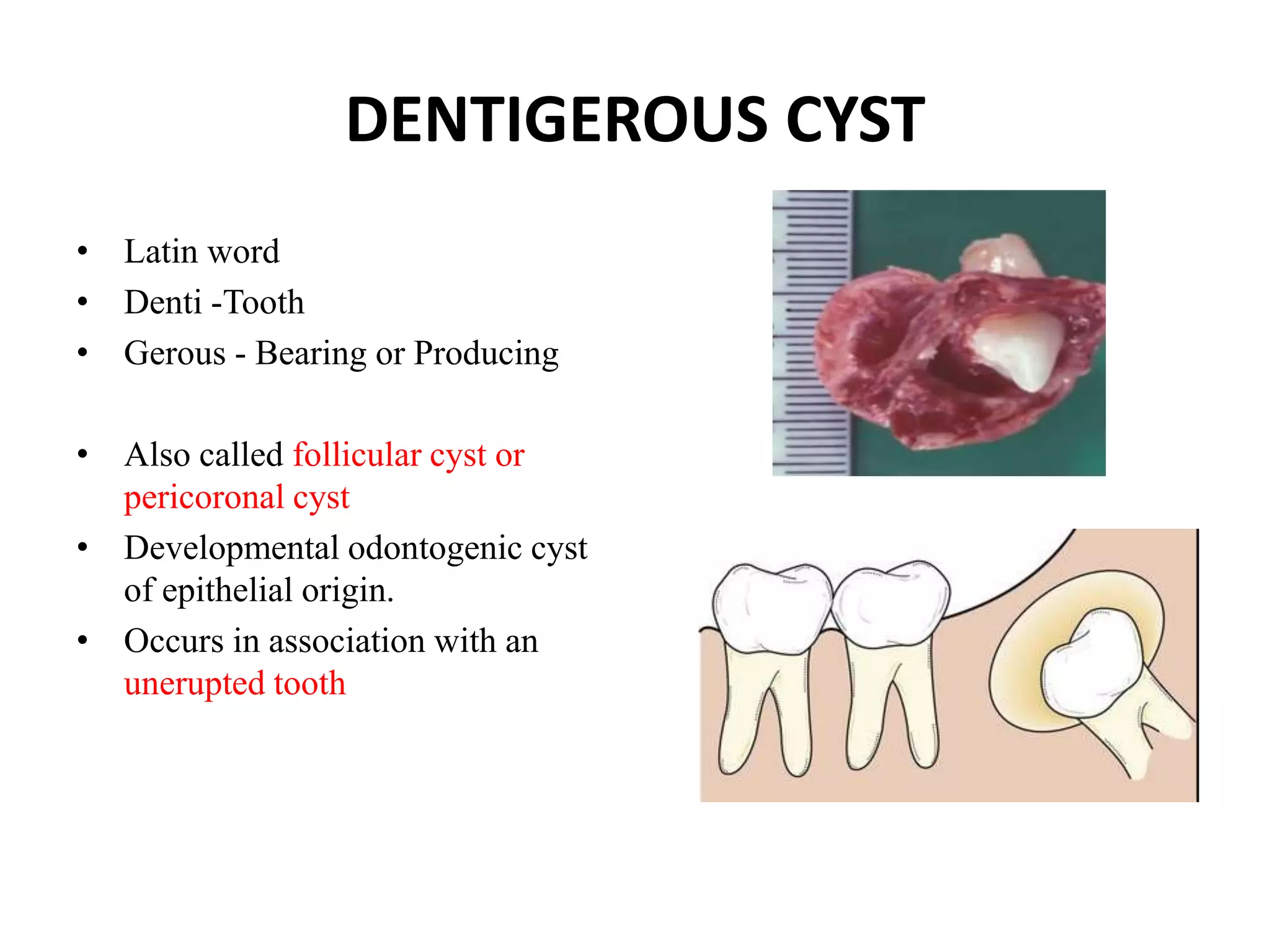 Dentigerous cyst | PPTX