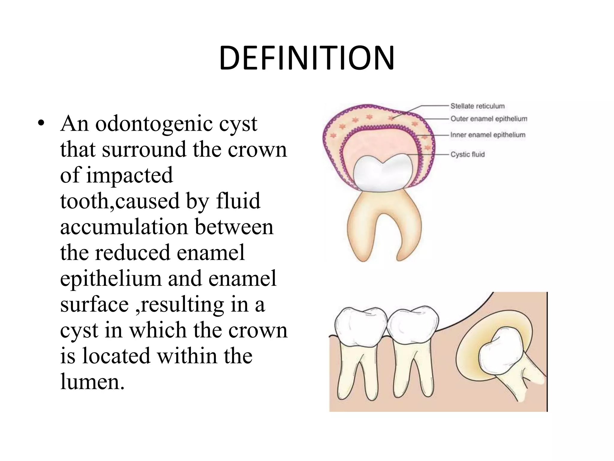 Dentigerous cyst | PPTX