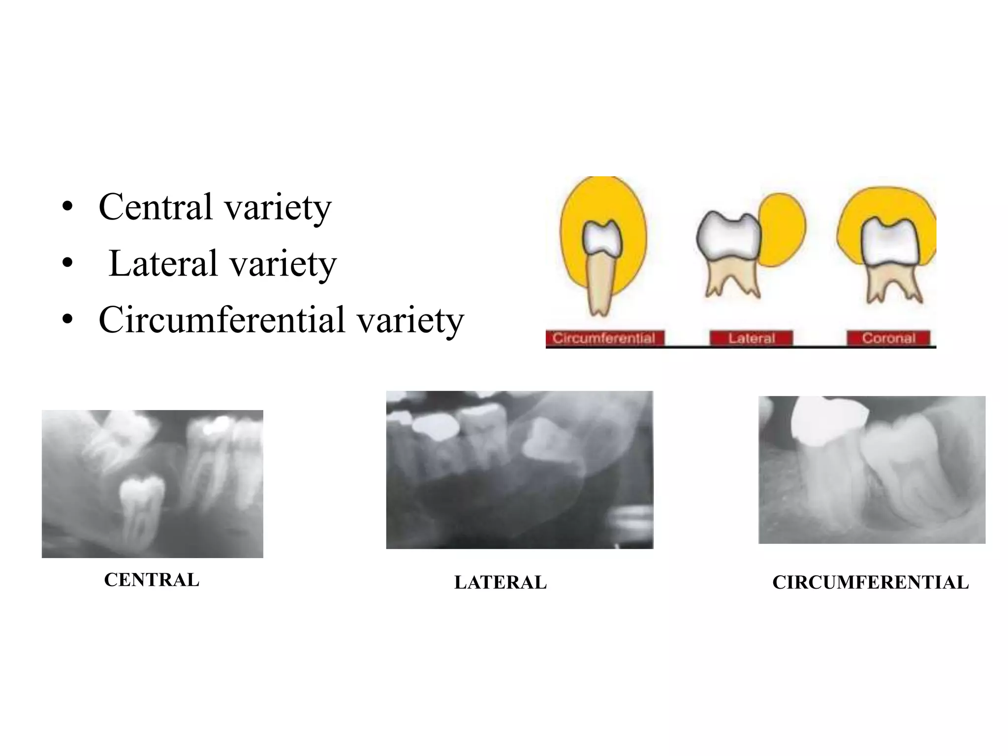 Dentigerous cyst | PPTX