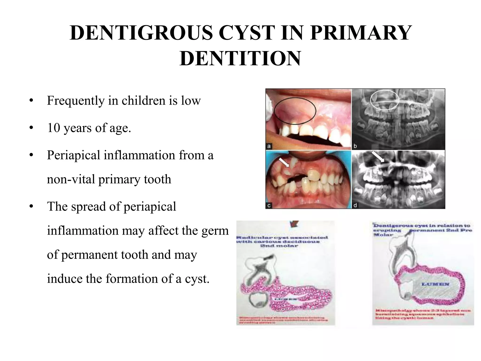 Dentigerous cyst | PPTX