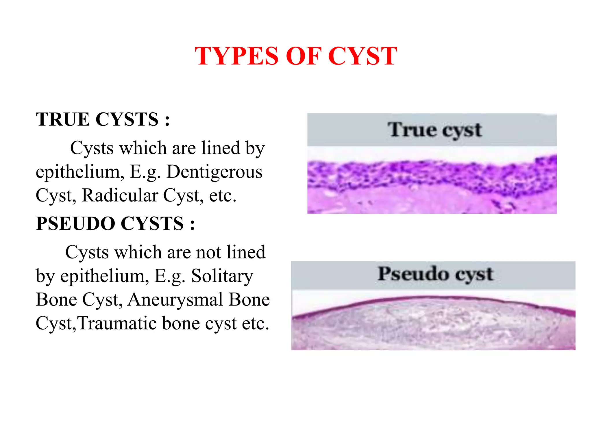 Dentigerous cyst | PPTX