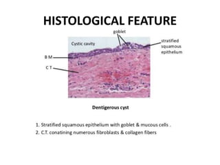 Residual Cyst Histology