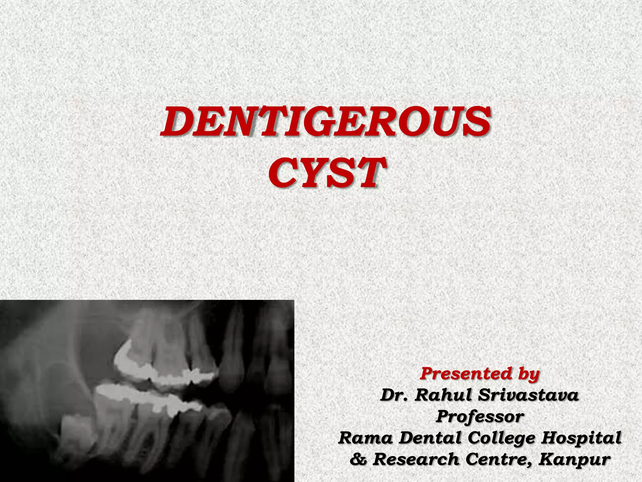 Dentigerous Cyst.ppt