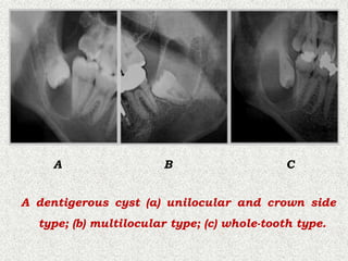 Dentigerous Cyst.ppt