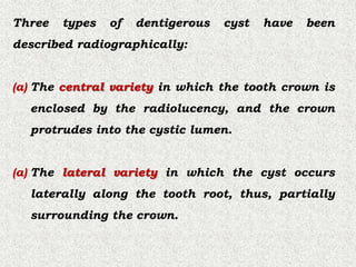 Dentigerous Cyst.ppt