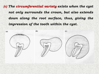 Dentigerous Cyst.ppt