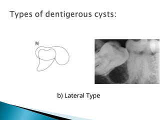 DENTIGEROUS CYST ORAL PATHOLOGY DENTISTRY | PPT