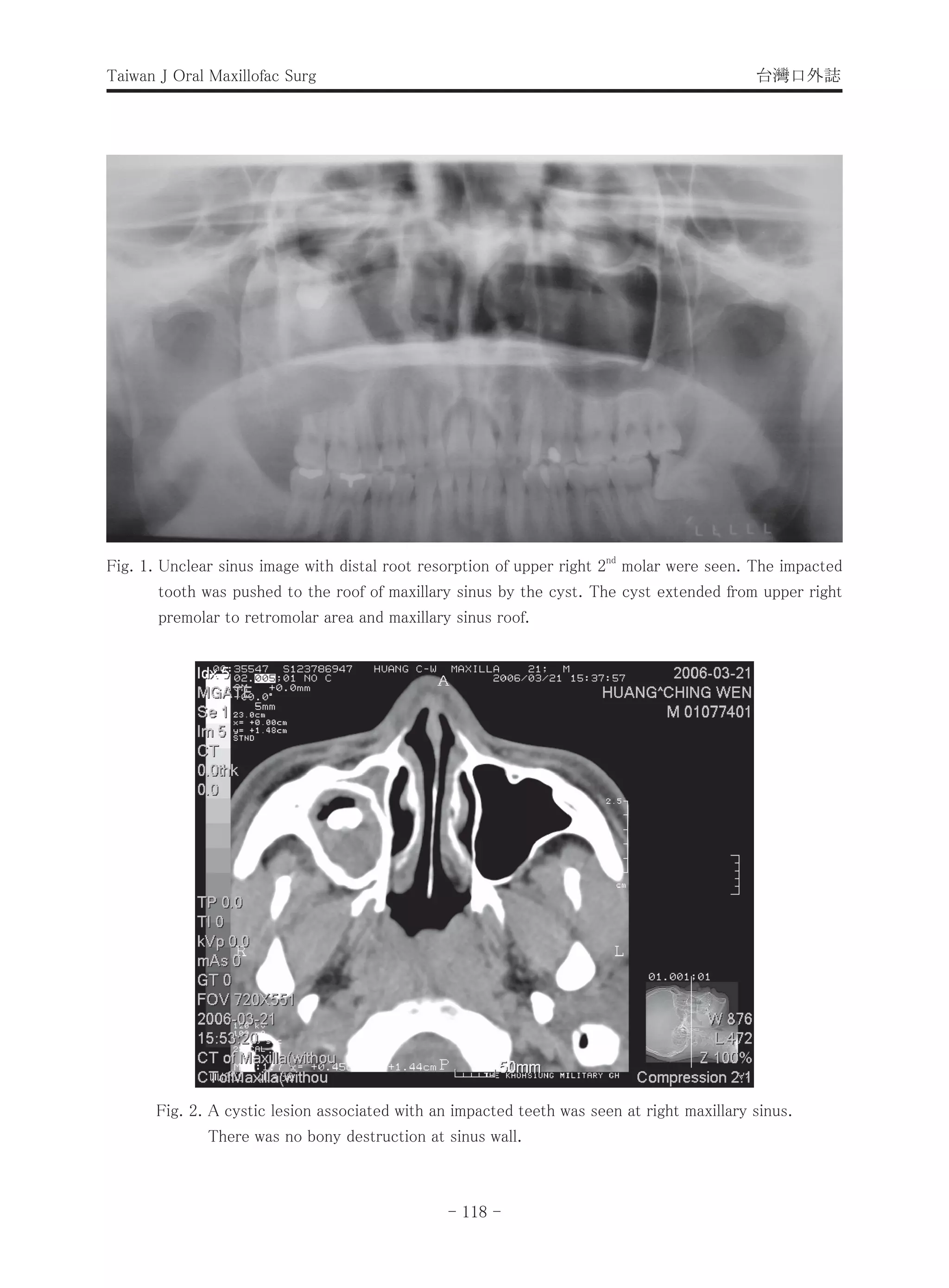 Dentigerous cyst over maxillary sinus a case report and literature ...