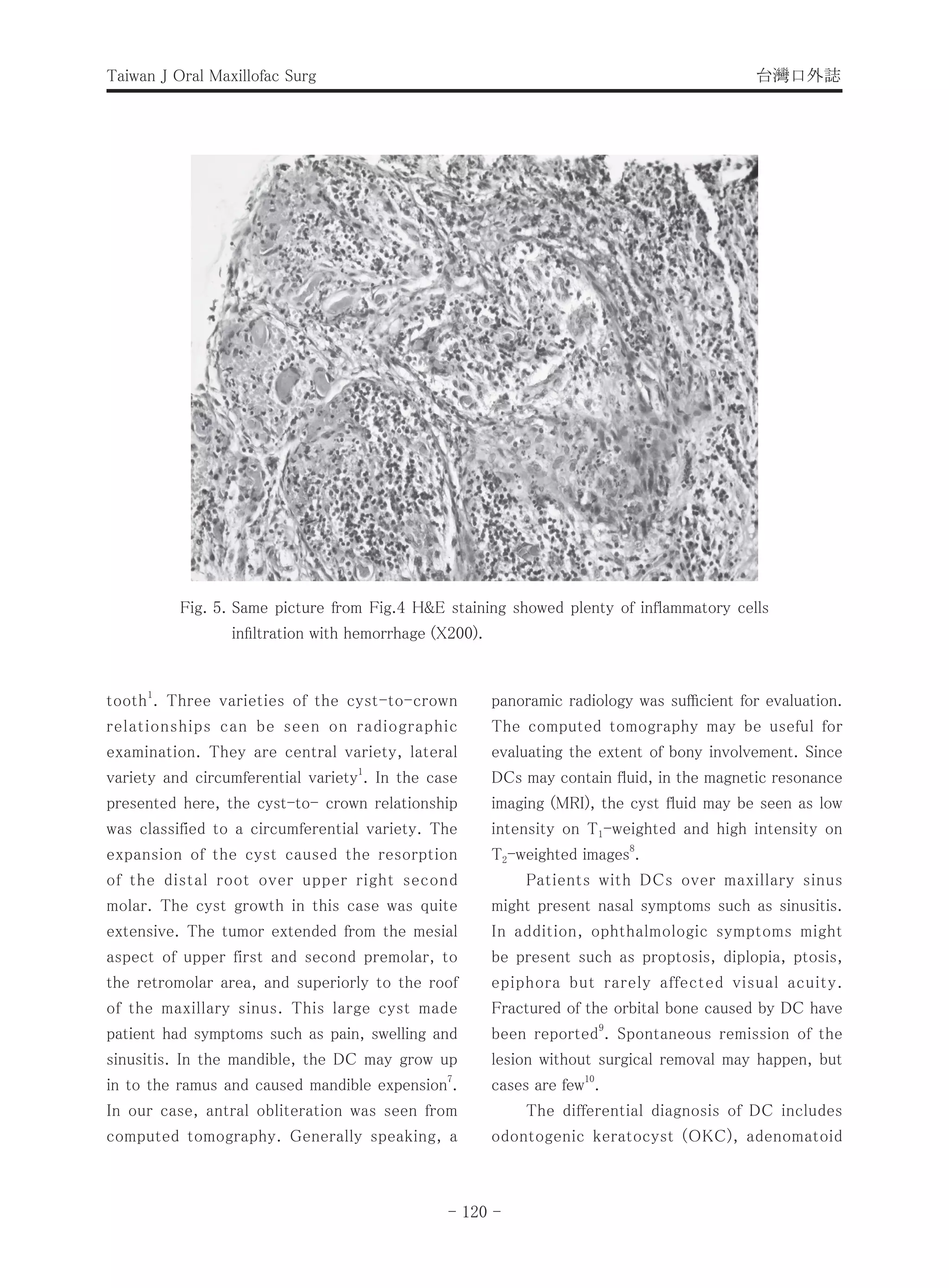 Dentigerous cyst over maxillary sinus a case report and literature ...
