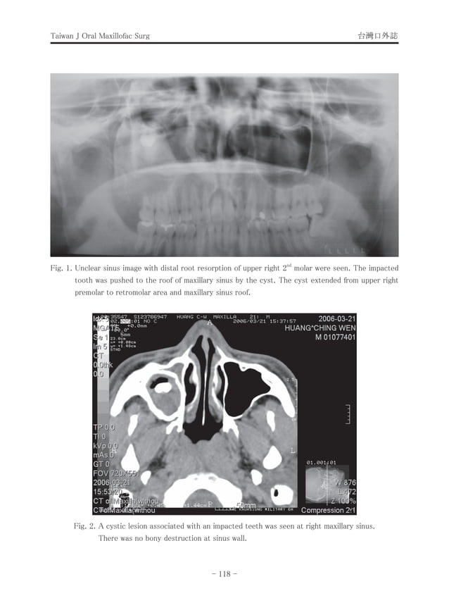 Dentigerous cyst over maxillary sinus a case report and literature ...