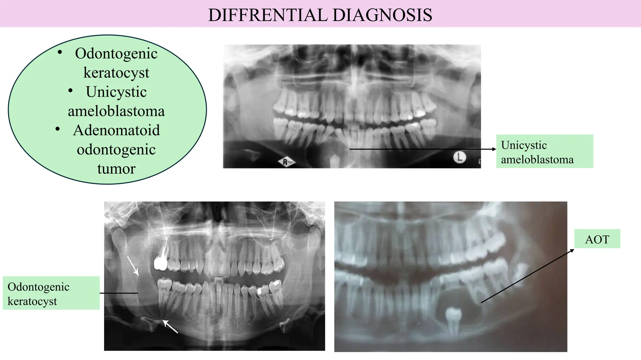 DENTIGEROUS CYST (FOLLICULAR CYST) PPT | PPTX